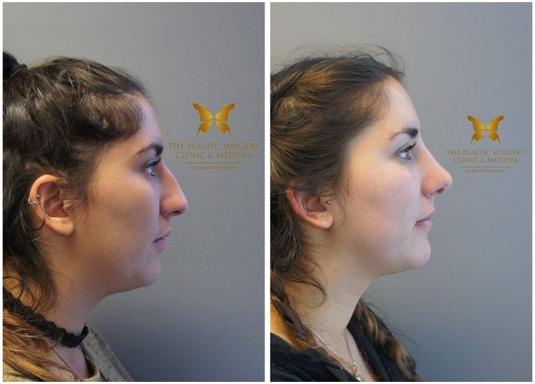 Rhinoplasty Gallery | Nose Job Before and After | Dr Reddy