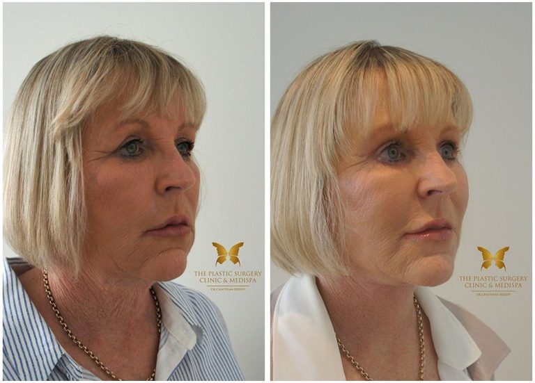 Neck Lift Sydney | The Plastic Surgery Clinic - Dr Reddy