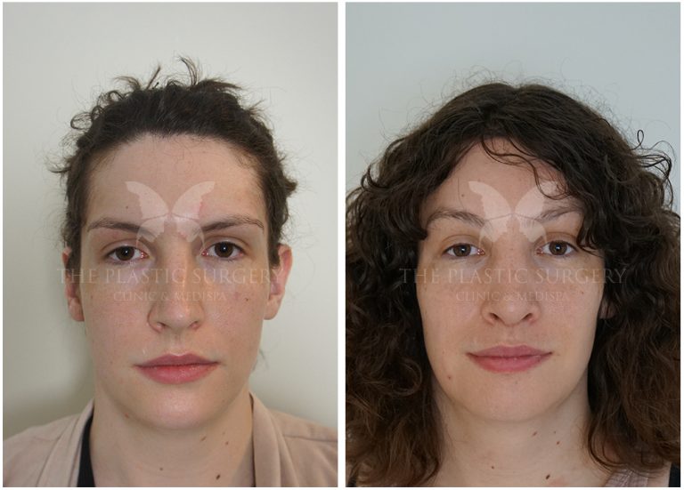 Facial Feminisation Sydney | The Plastic Surgery Clinic