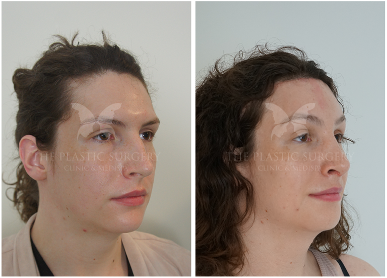 Facial Feminisation Sydney | The Plastic Surgery Clinic