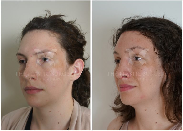 Facial Feminisation Sydney | The Plastic Surgery Clinic