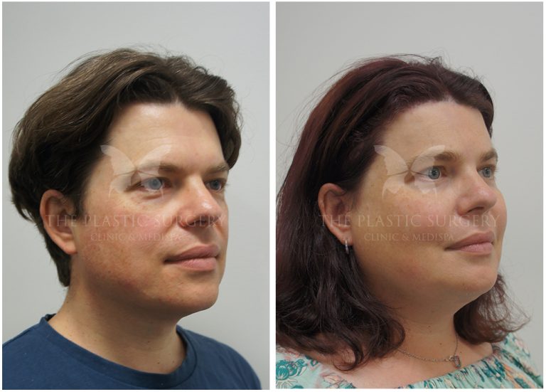 Facial Feminisation Sydney | The Plastic Surgery Clinic