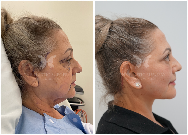 Neck Lift Sydney | The Plastic Surgery Clinic - Dr Reddy